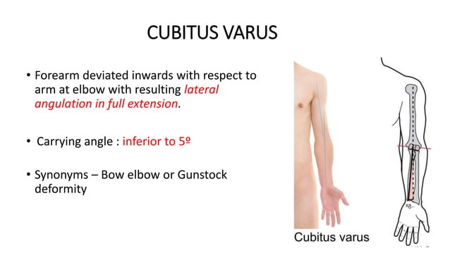 Cubitus valgus varus
