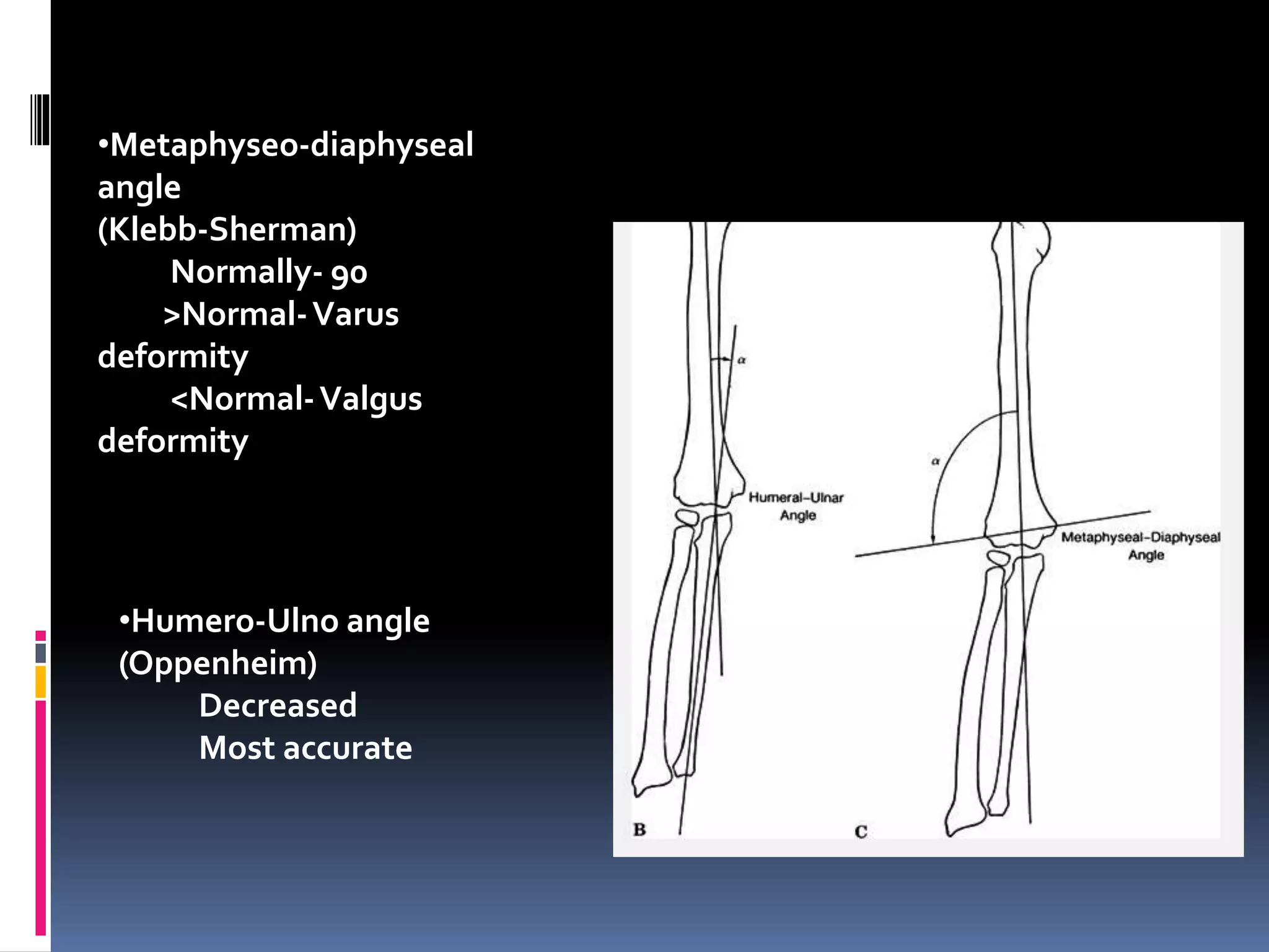 Cubitus varus by Dhrumil Patel | PPTX