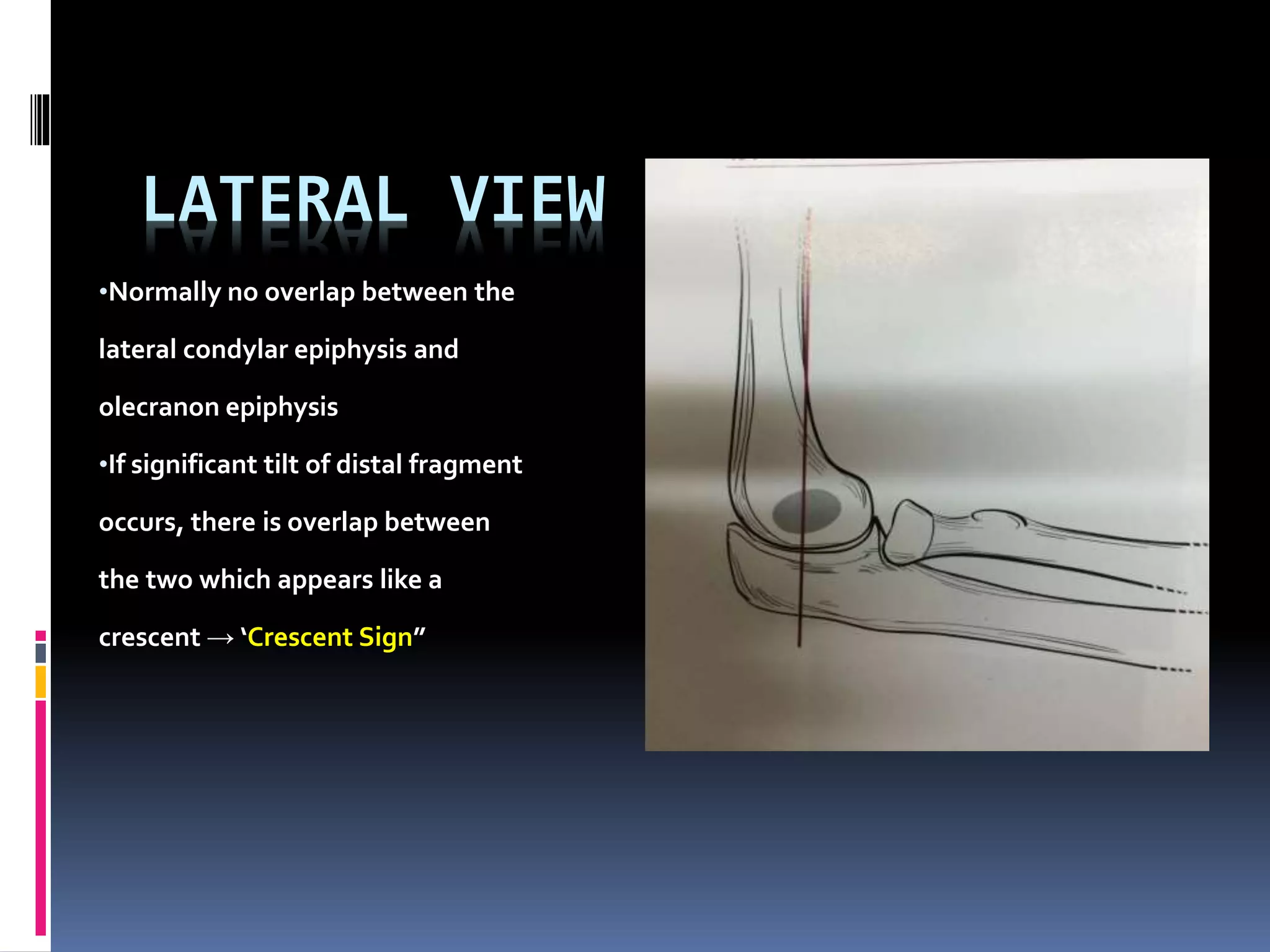Cubitus varus by Dhrumil Patel | PPTX