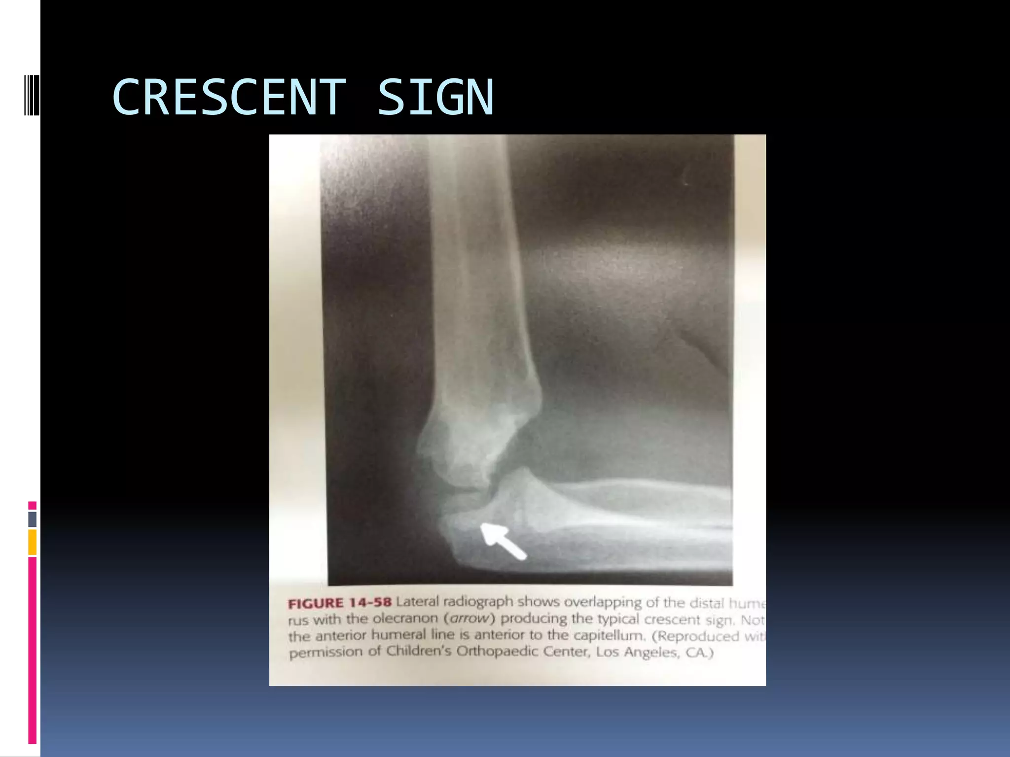 Cubitus varus by Dhrumil Patel | PPTX