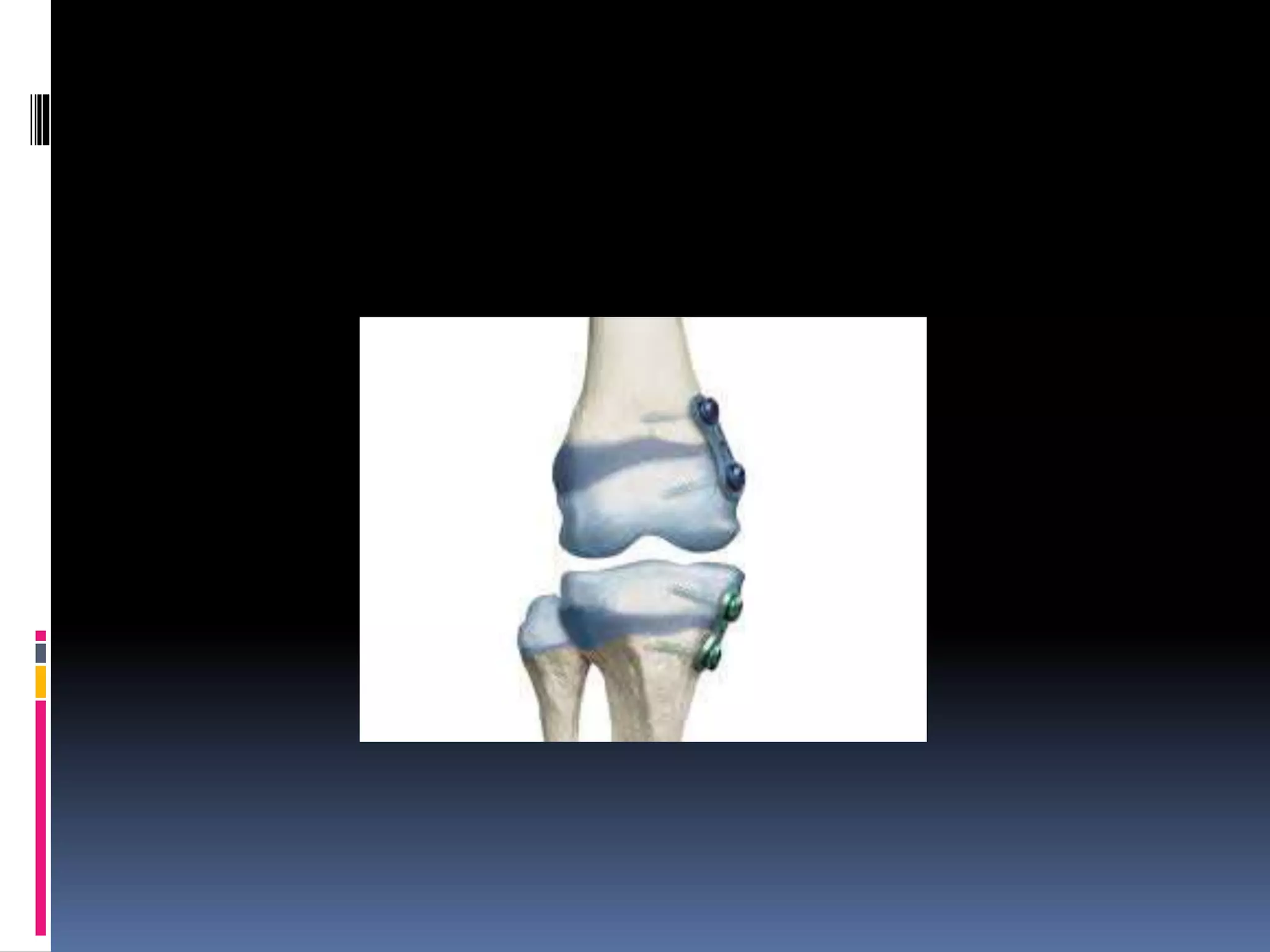 Cubitus varus by Dhrumil Patel | PPTX