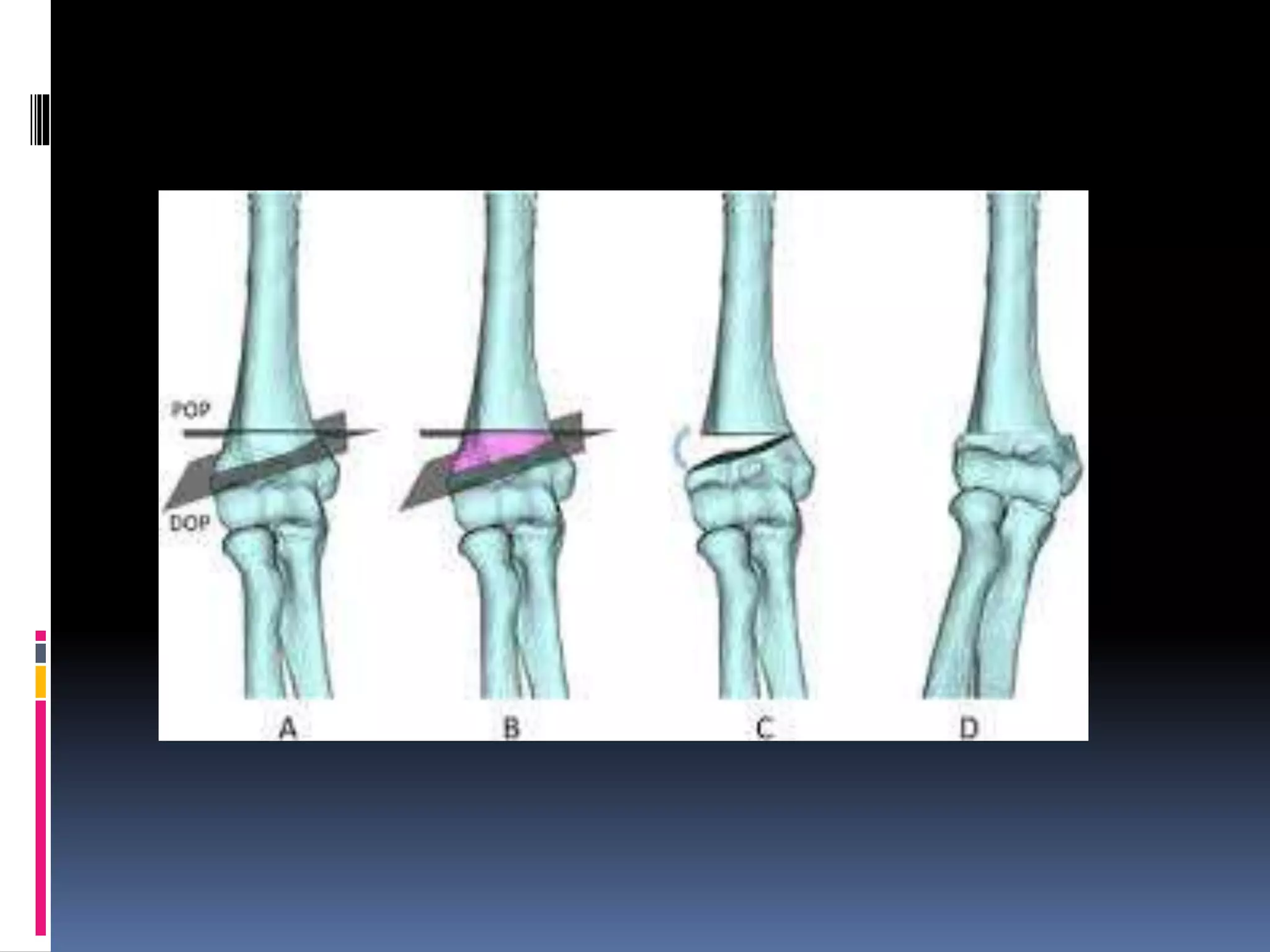Cubitus varus by Dhrumil Patel | PPTX