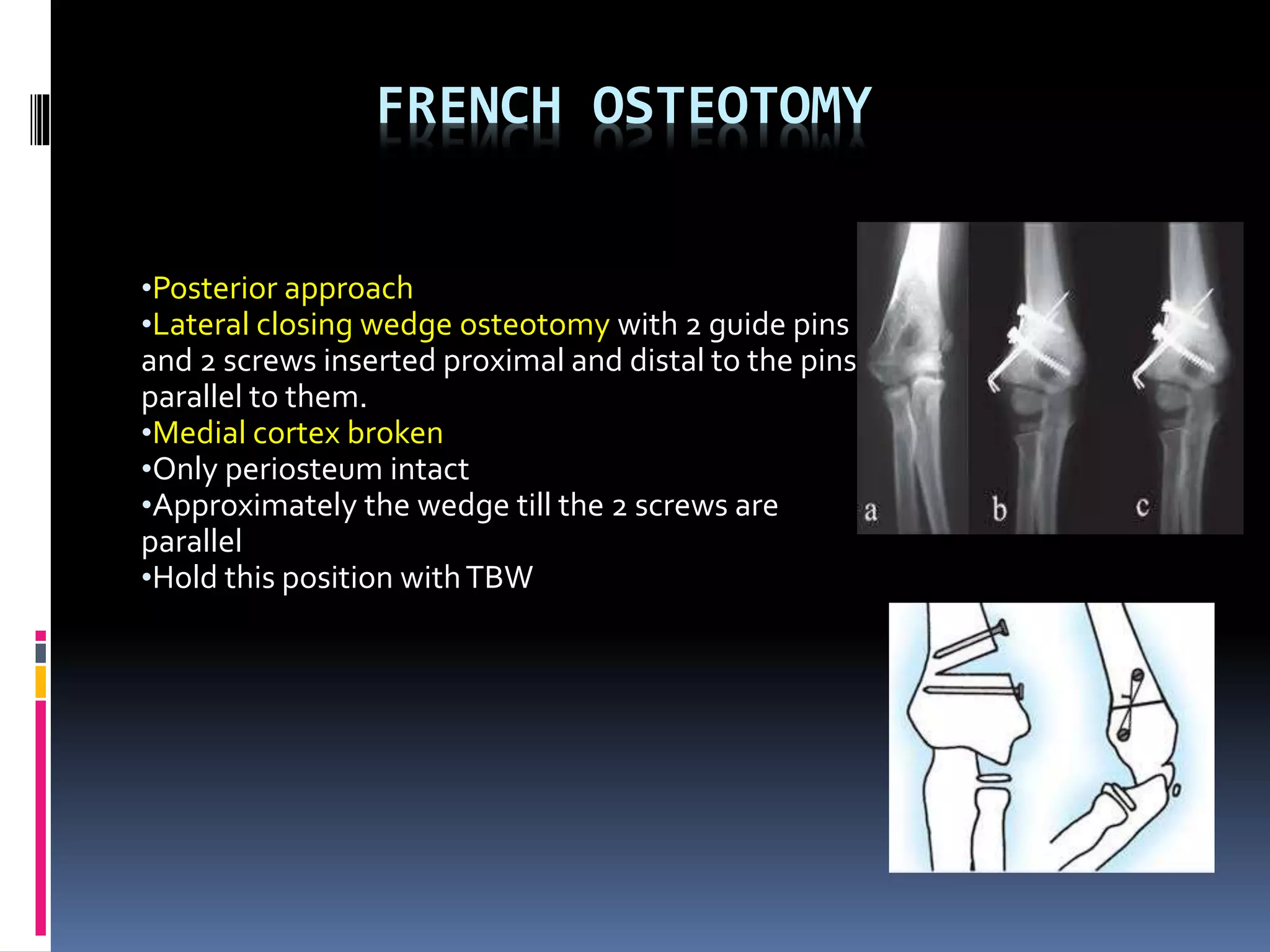 Cubitus varus by Dhrumil Patel | PPTX