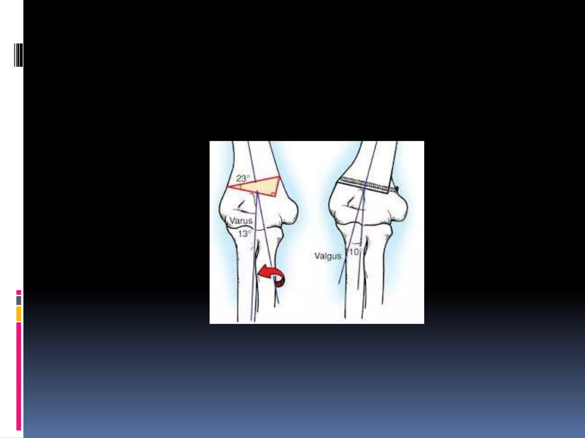 Cubitus varus by Dhrumil Patel | PPTX