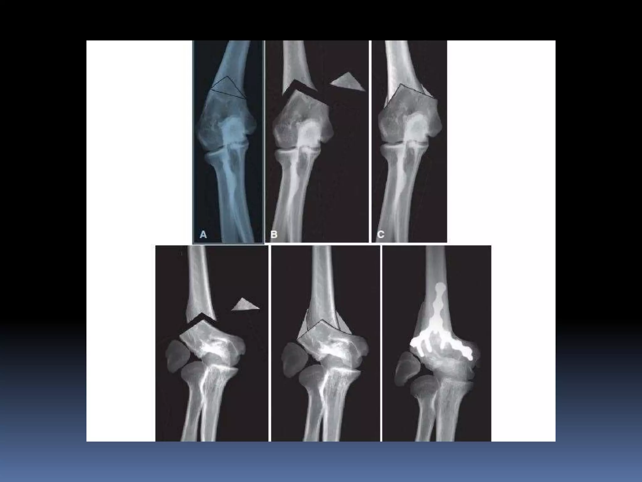 Cubitus varus by Dhrumil Patel | PPTX