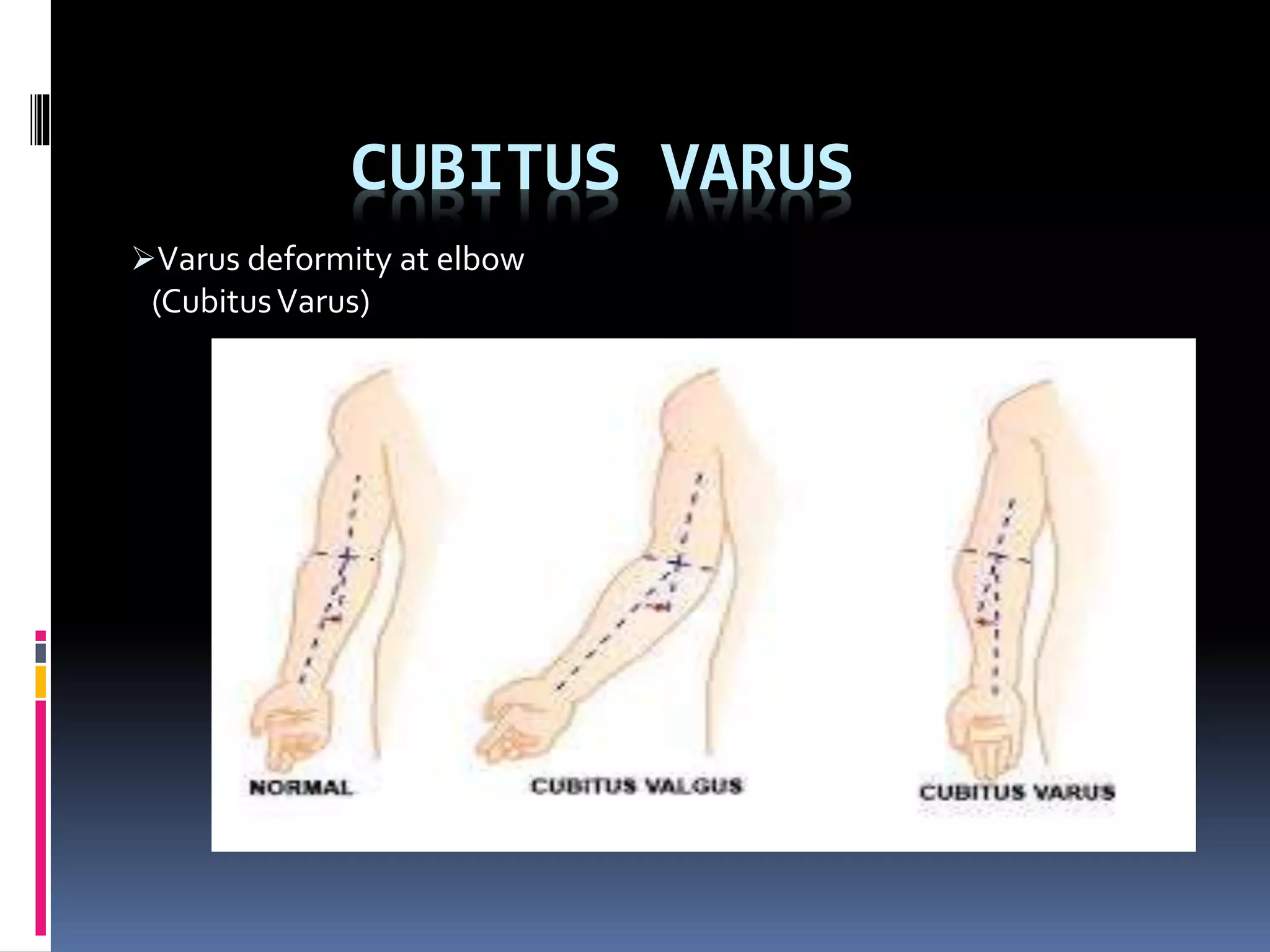 Cubitus varus by Dhrumil Patel | PPTX