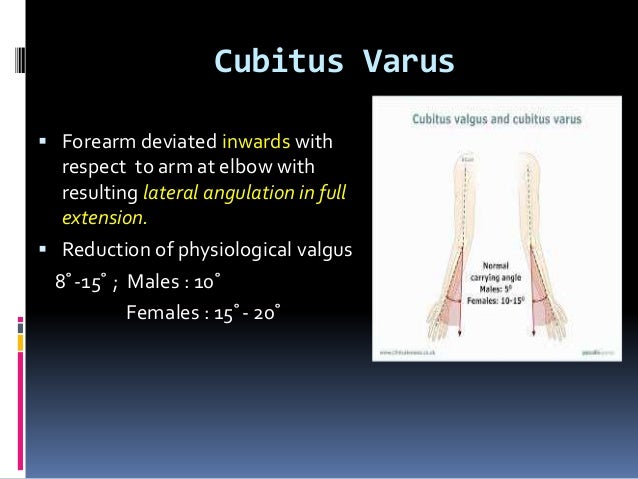 Cubitus varus by Dhrumil Patel