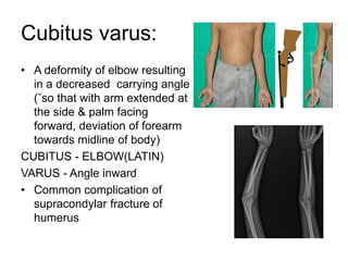 Cubitus varus | PPT