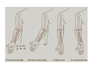 Cubitus varus | PPT
