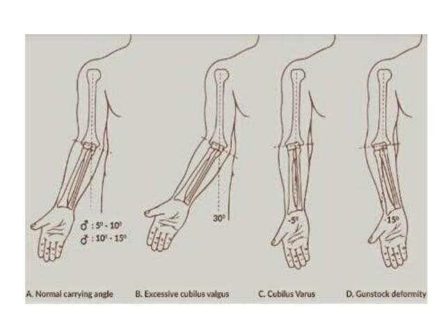 Cubitus varus | PPT