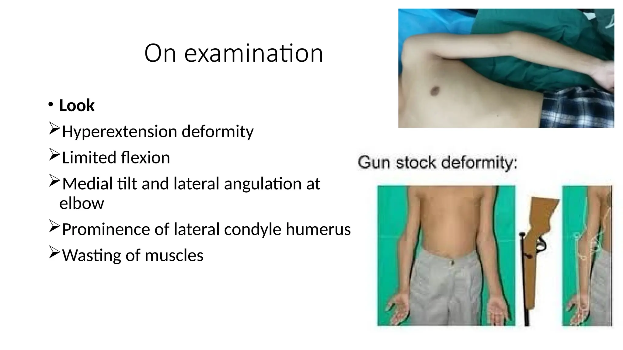 CUBITUS VARUS AND VALGUS DEFORMITY .pptx