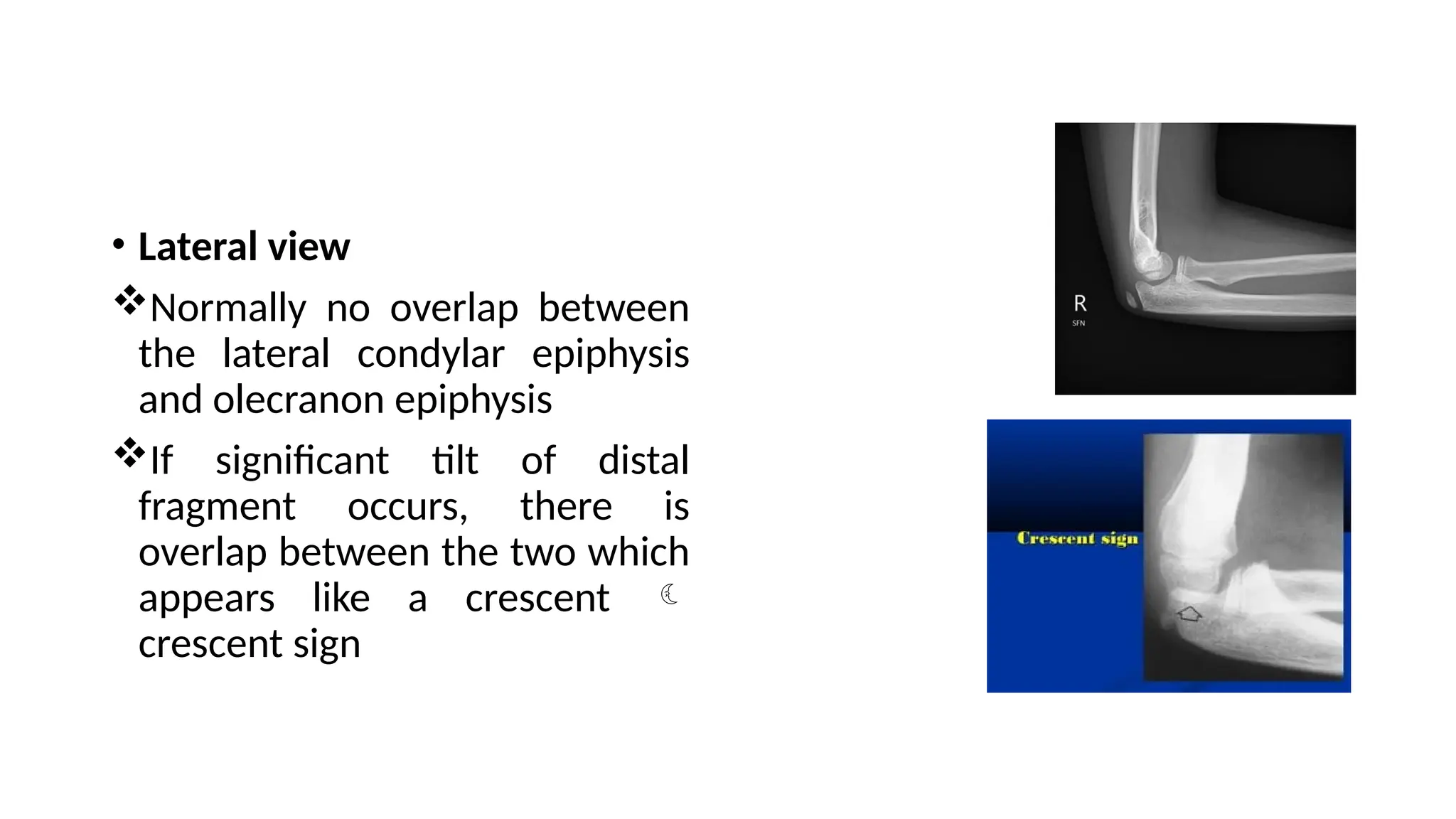 CUBITUS VARUS AND VALGUS DEFORMITY .pptx