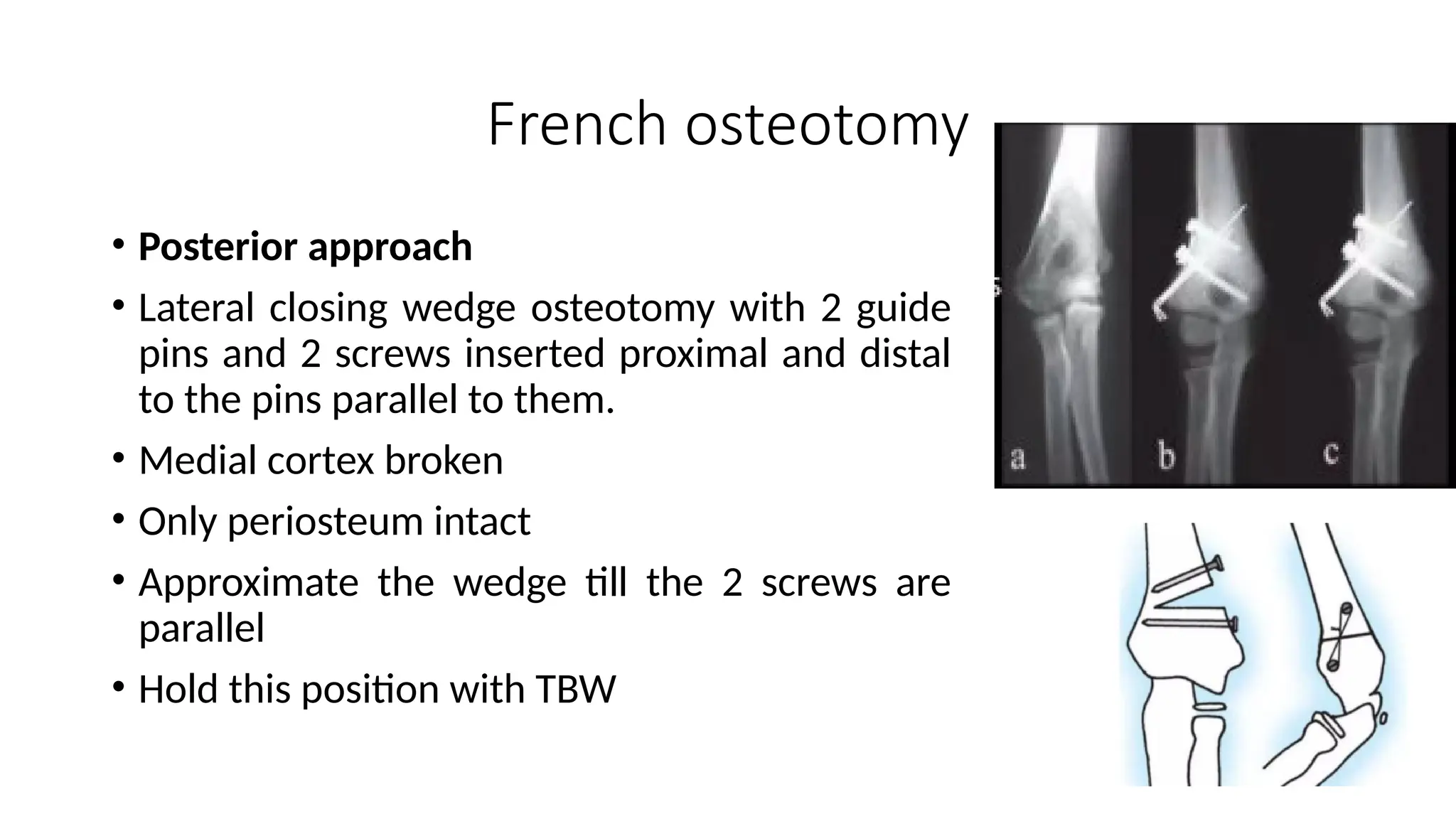 CUBITUS VARUS AND VALGUS DEFORMITY .pptx