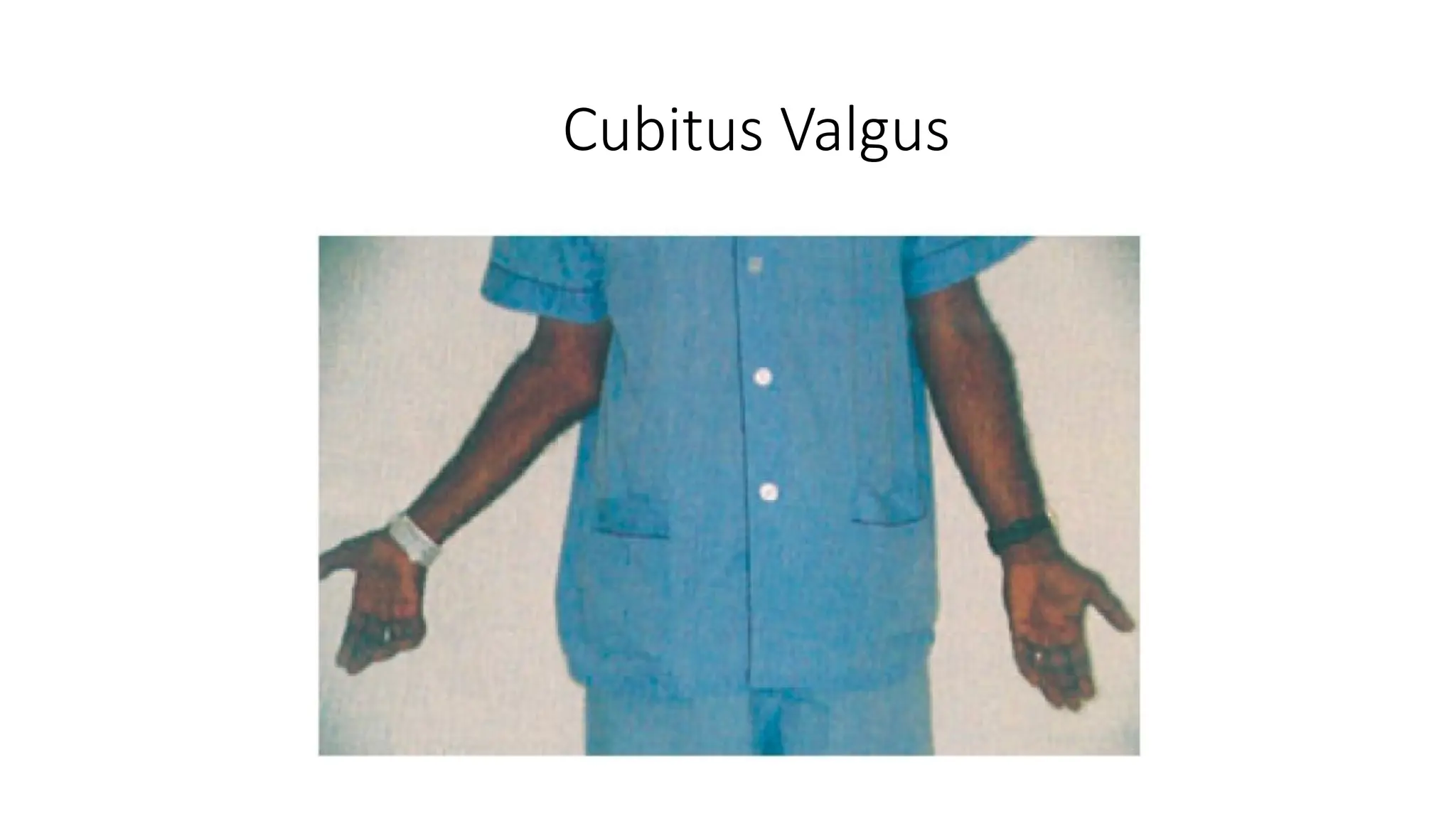 CUBITUS VARUS AND VALGUS DEFORMITY .pptx
