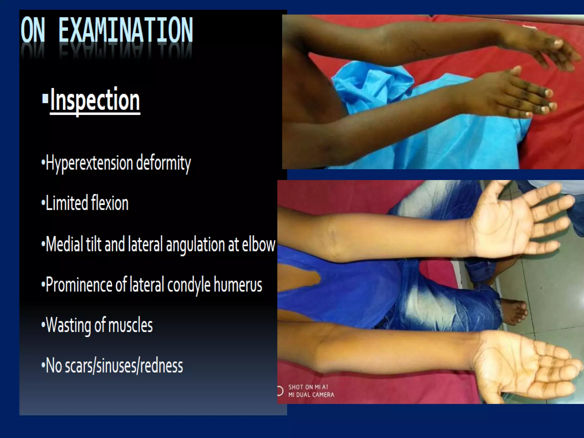 Cubitus varus deformity | PPTX