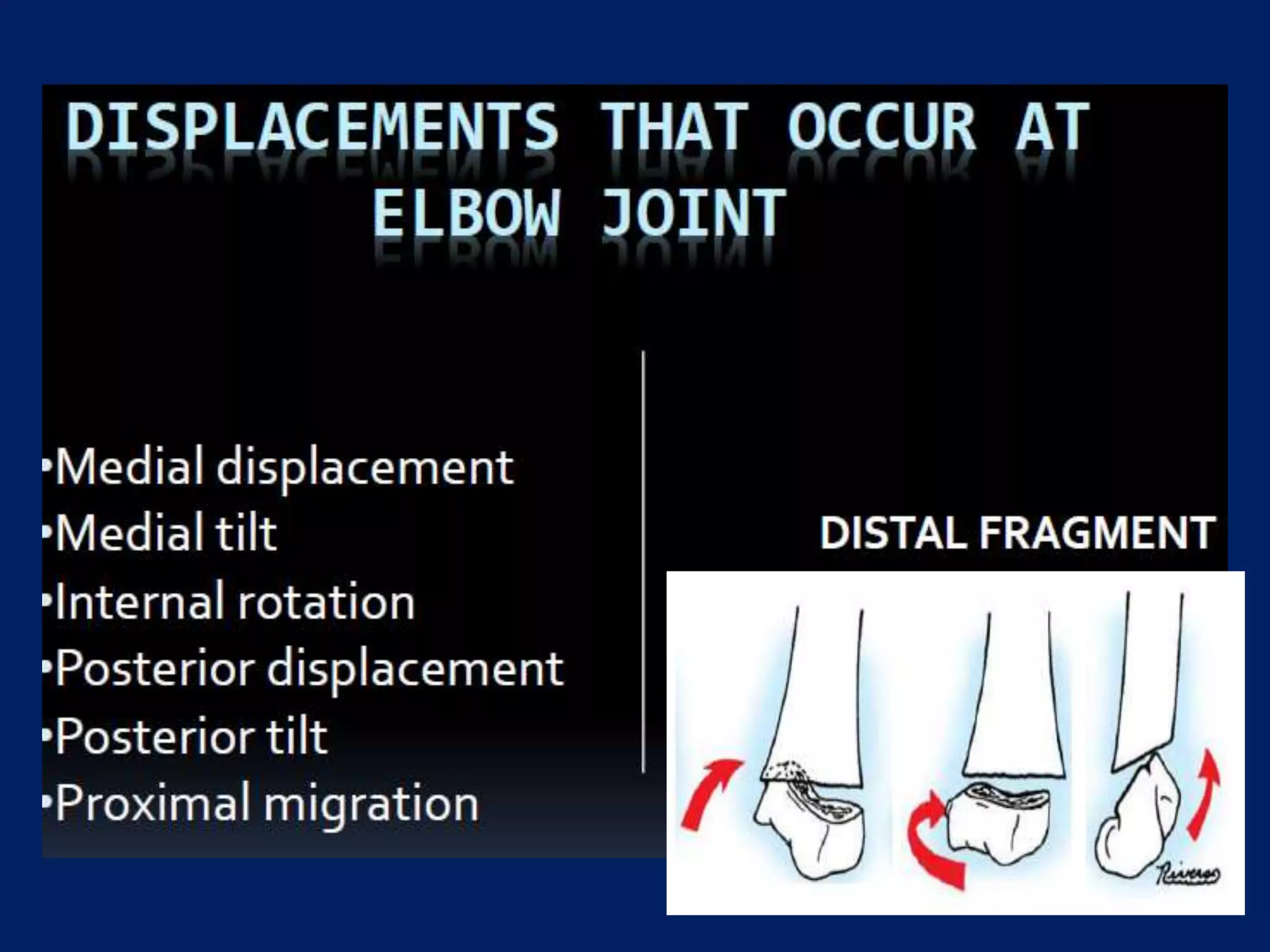 Cubitus varus deformity | PPTX