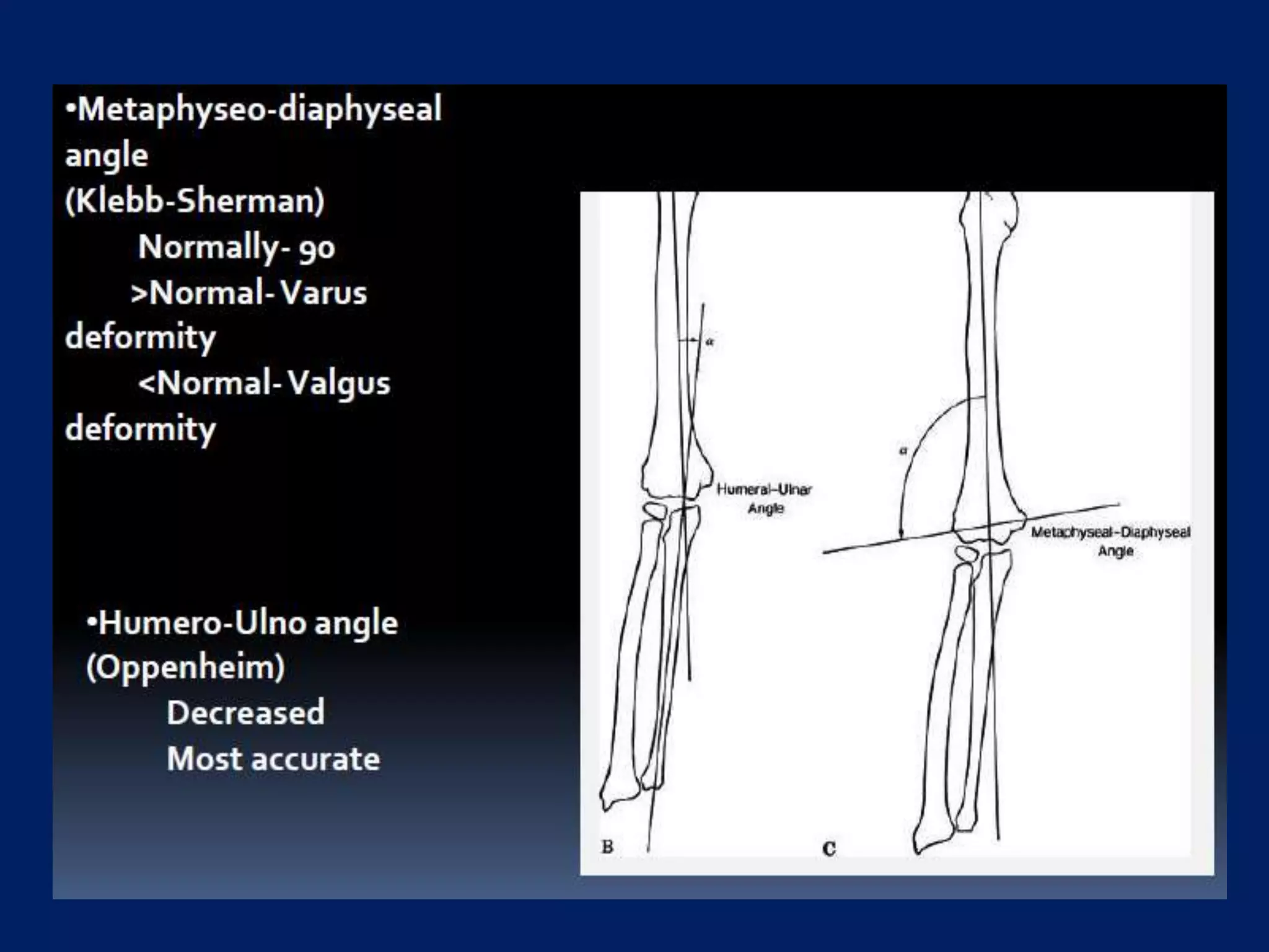 Cubitus varus deformity | PPTX