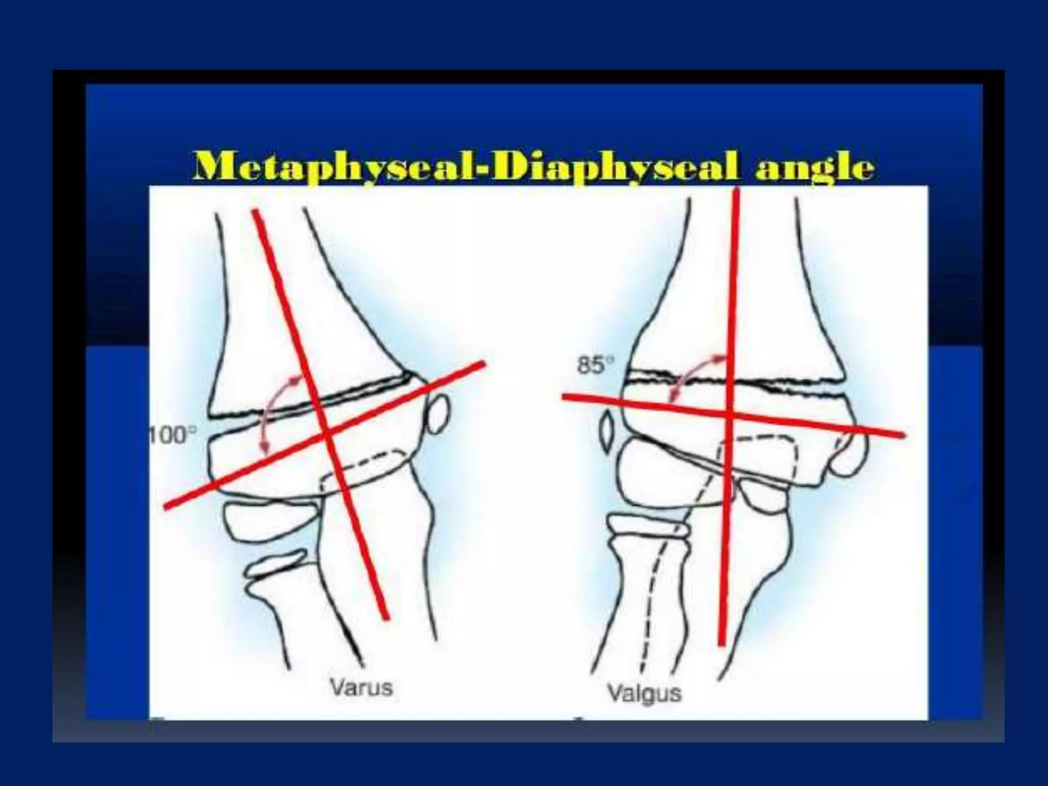 Cubitus varus deformity | PPTX