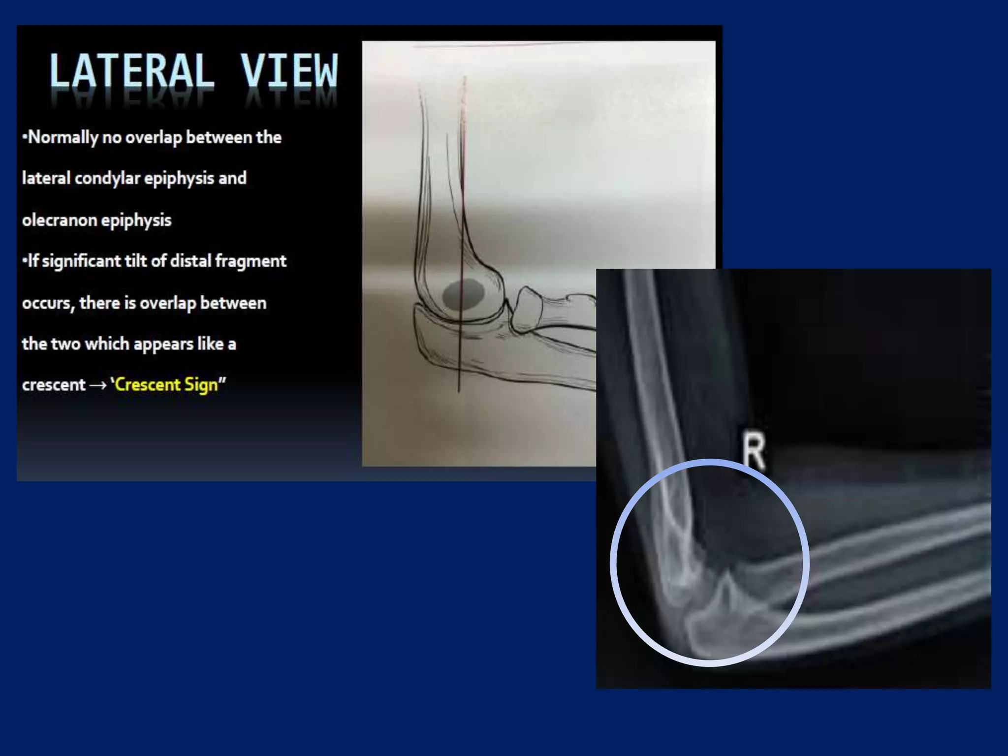 Cubitus varus deformity | PPTX