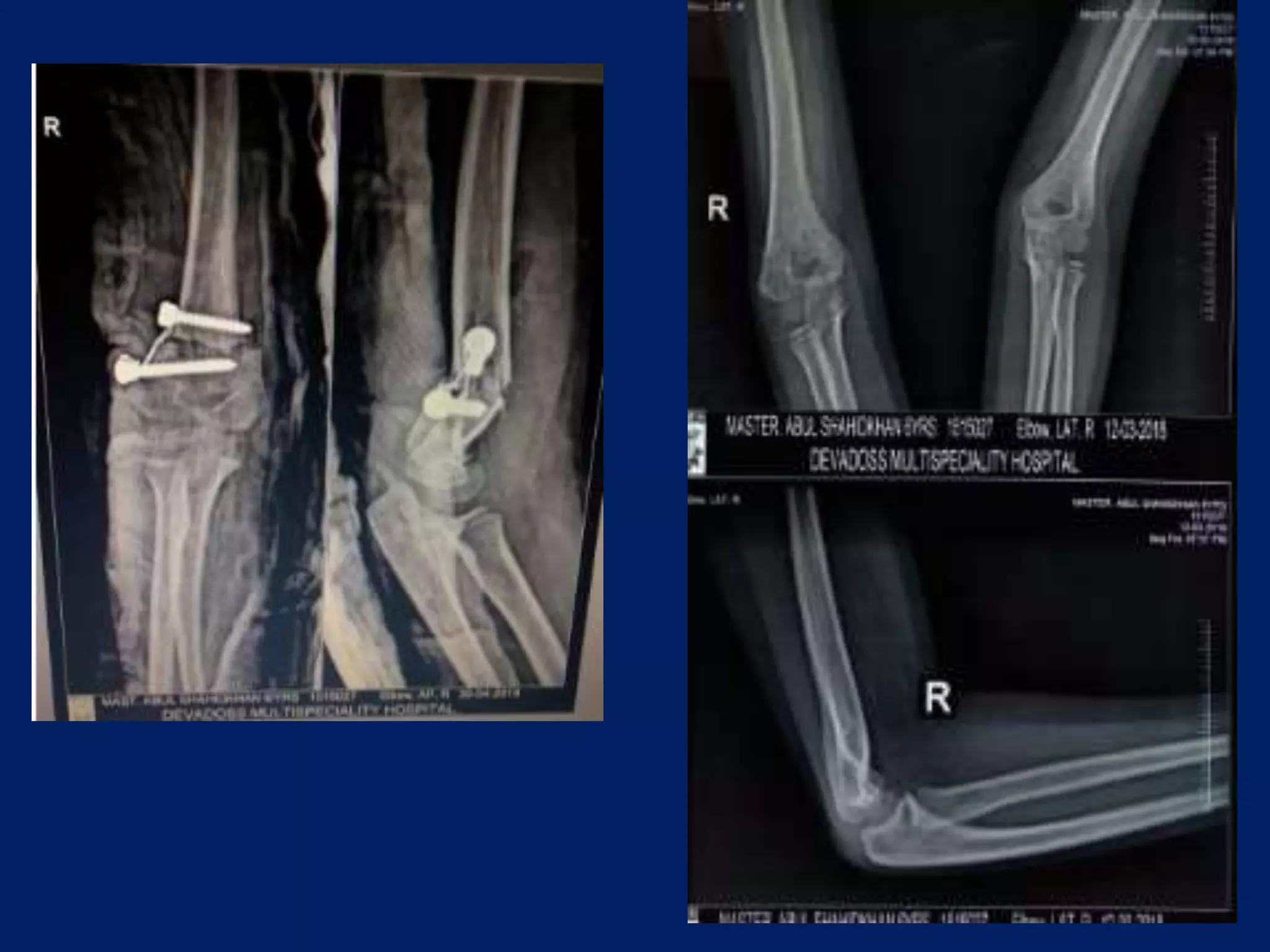 Cubitus varus deformity | PPTX