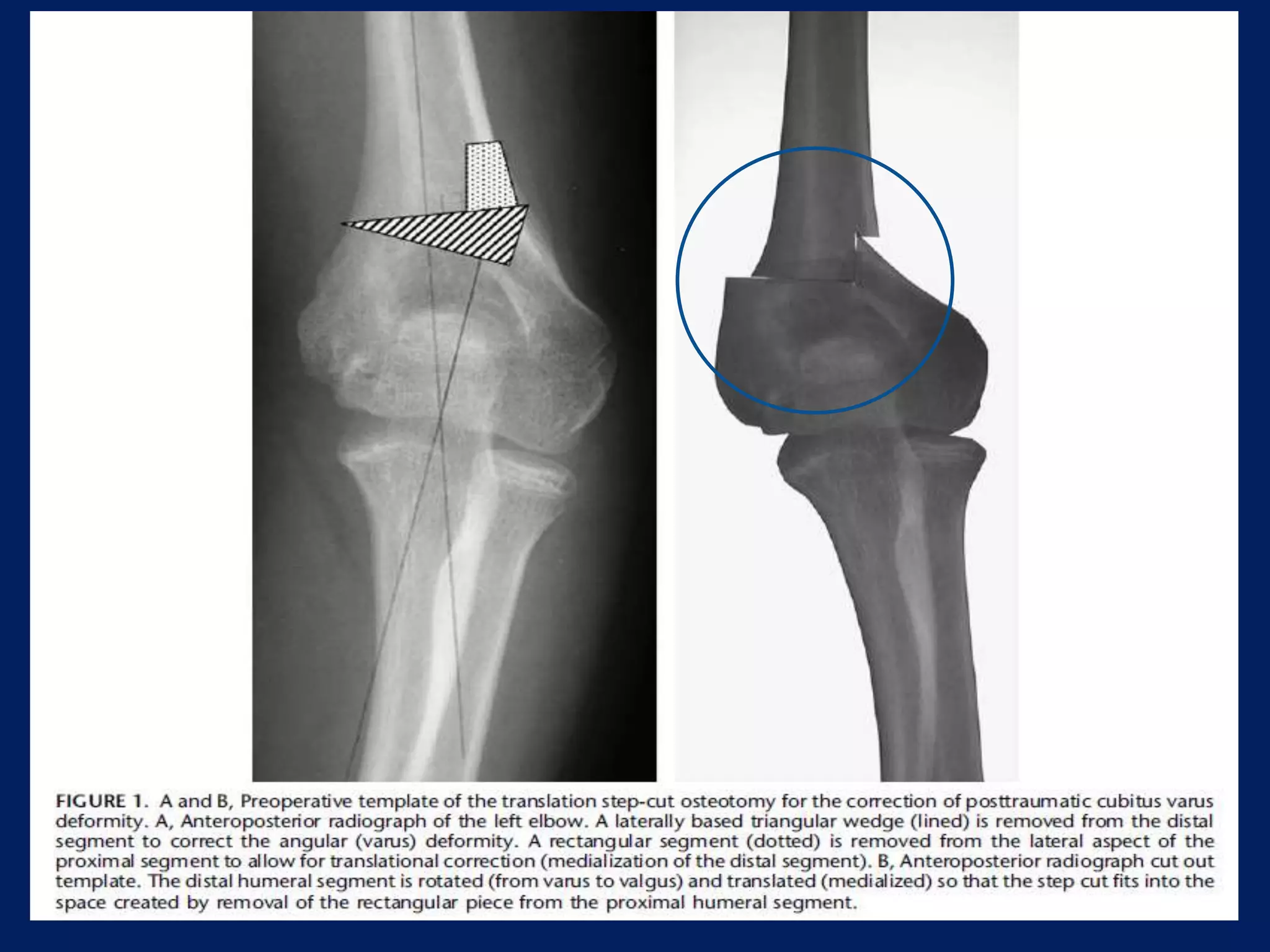 Cubitus varus deformity | PPTX