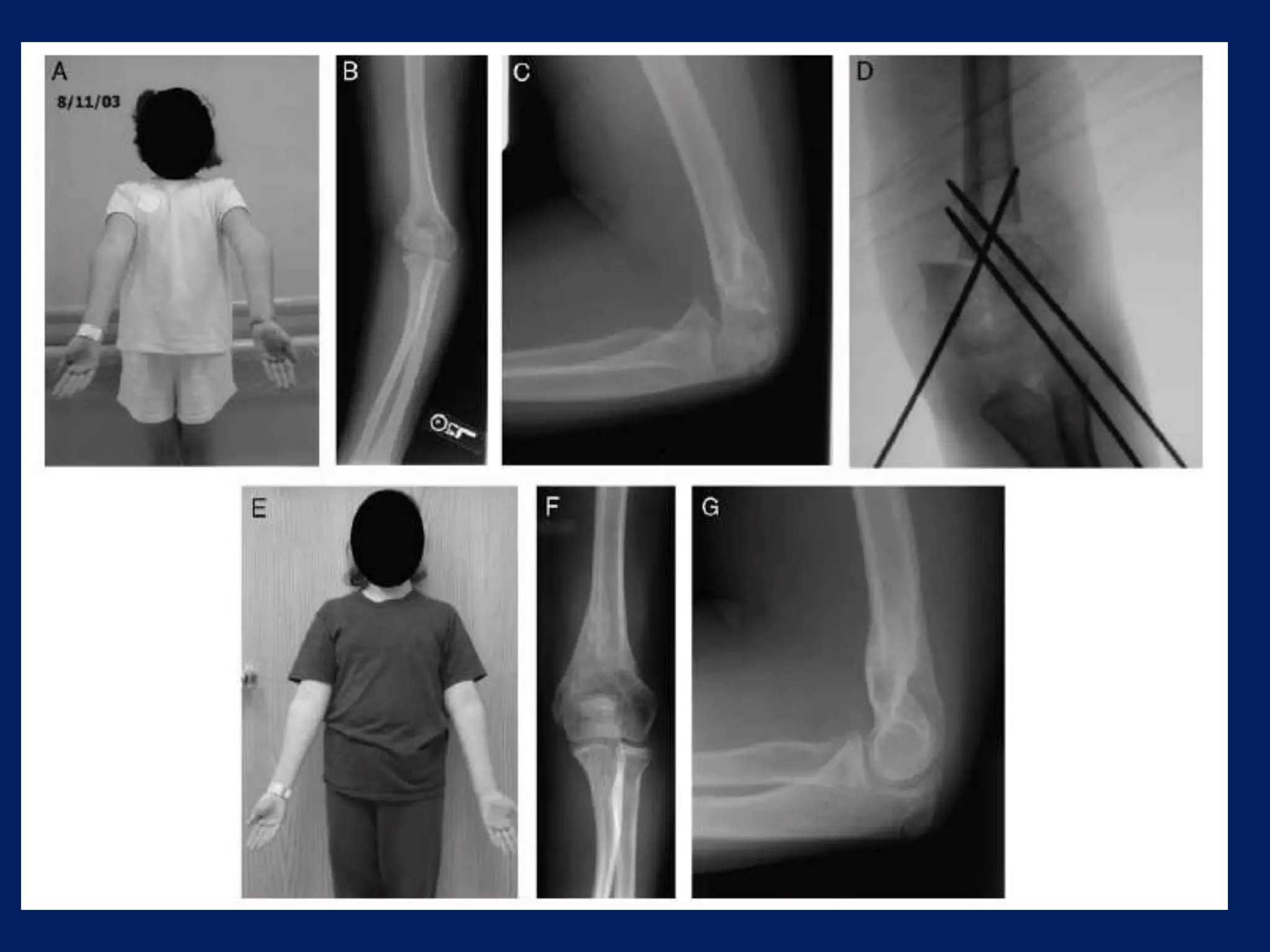 Cubitus varus deformity | PPTX