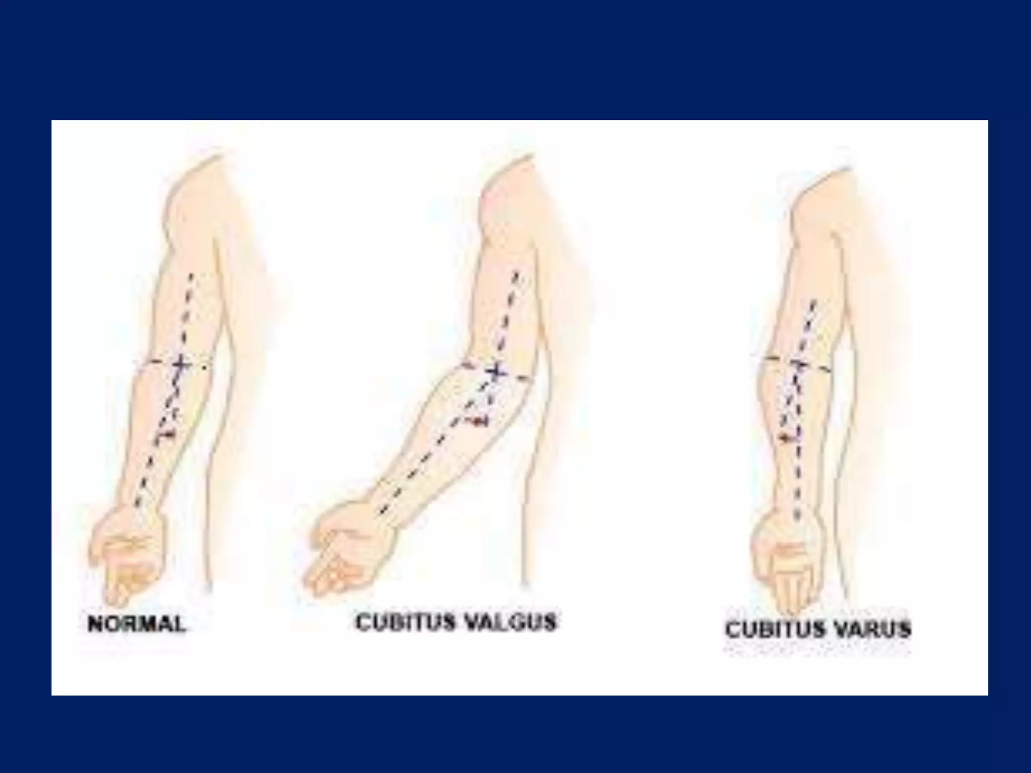 Cubitus varus deformity | PPTX