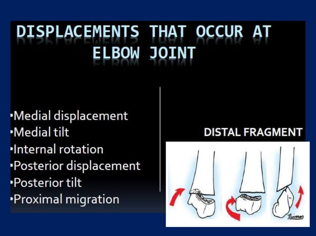 Cubitus varus deformity | PPTX
