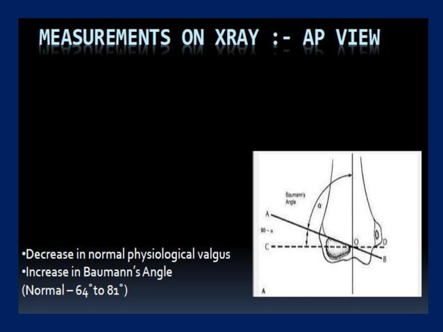 Cubitus varus deformity | PPTX