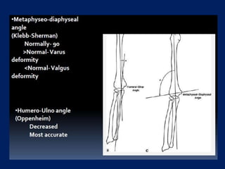 Cubitus varus deformity | PPTX