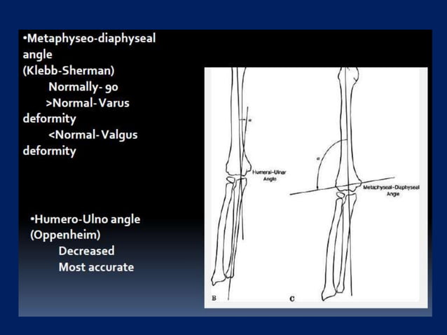 Cubitus varus deformity | PPTX