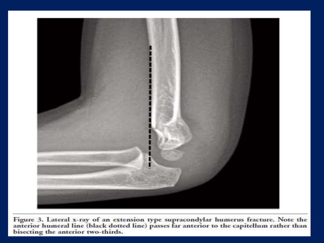 Cubitus varus deformity | PPTX