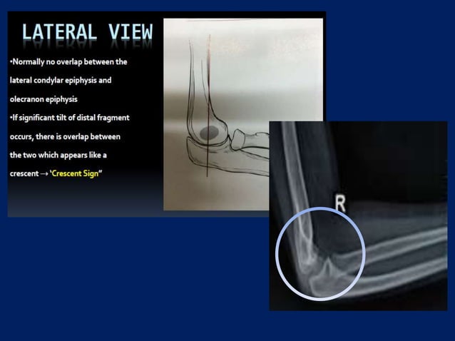 Cubitus varus deformity | PPTX