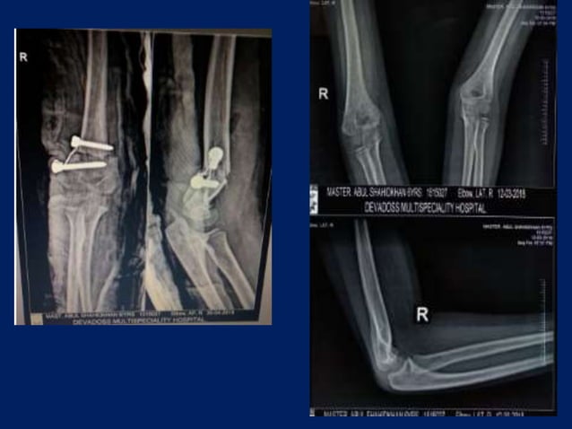 Cubitus varus deformity | PPTX
