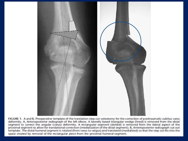 Cubitus varus deformity | PPTX