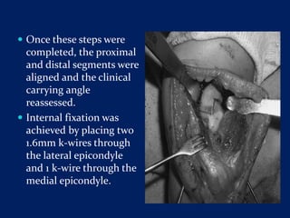 Cubitus varus deformity | PPTX