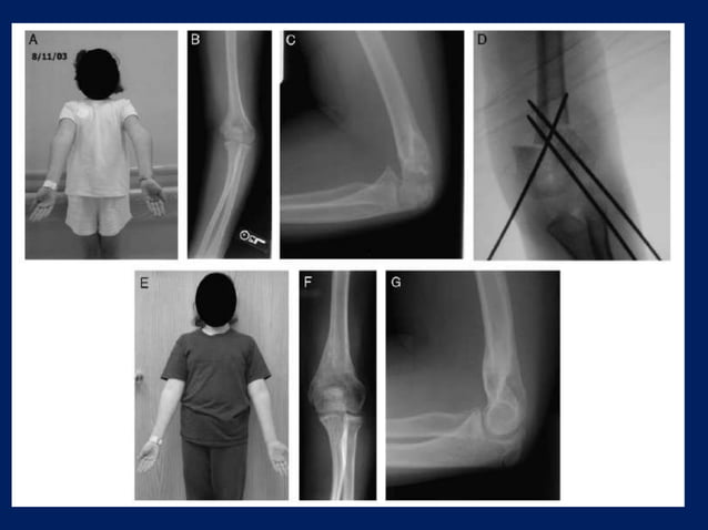 Cubitus varus deformity | PPTX