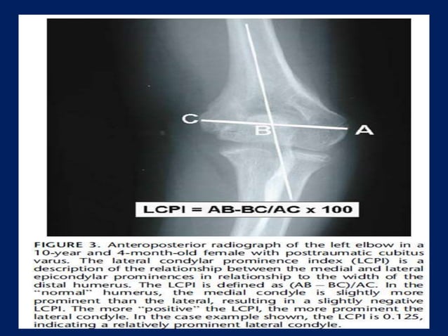 Cubitus varus deformity | PPTX