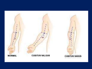 Cubitus Valgus And Cubitus Varus