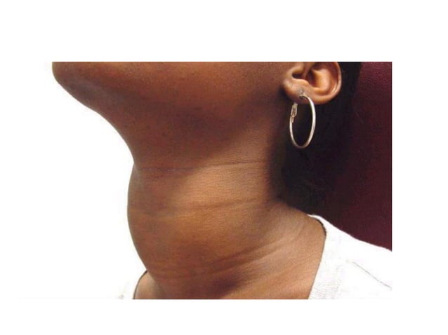 Cuello descripcion anatomica con explicacion facil | PDF | Thyroid ...