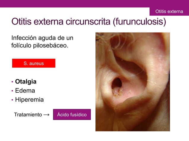 Cuerpos extraños en oído y otitis externa | PPTX