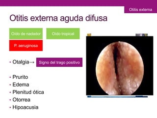 Cuerpos extraños en oído y otitis externa | PPTX
