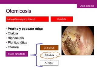 Cuerpos extraños en oído y otitis externa | PPTX