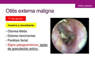 Cuerpos extraños en oído y otitis externa | PPTX