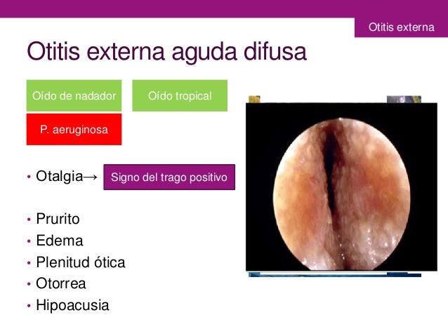 Otitis Externa Difusa – OTITIS AGUDAS: Diferencia entre otitis externa ...