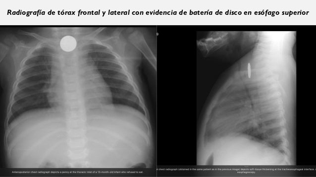 Cuerpos extraños en esófago