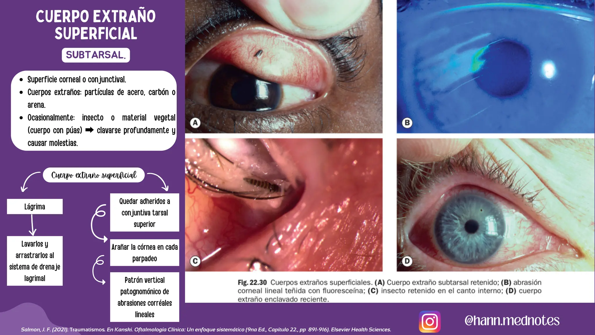 Cuerpos Extraños Oculares Superficiales E Intraoculares Pdf