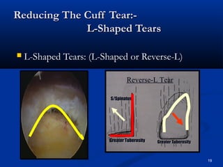 Cuff repair chris roberts | PPT