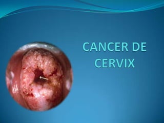 Cáncer de Cevix | PPTX