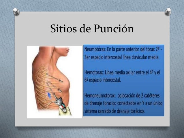 Cuidados de enfermería en toracocentesis